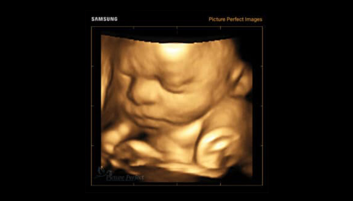 Ecografie 3D e 4D – DiLei